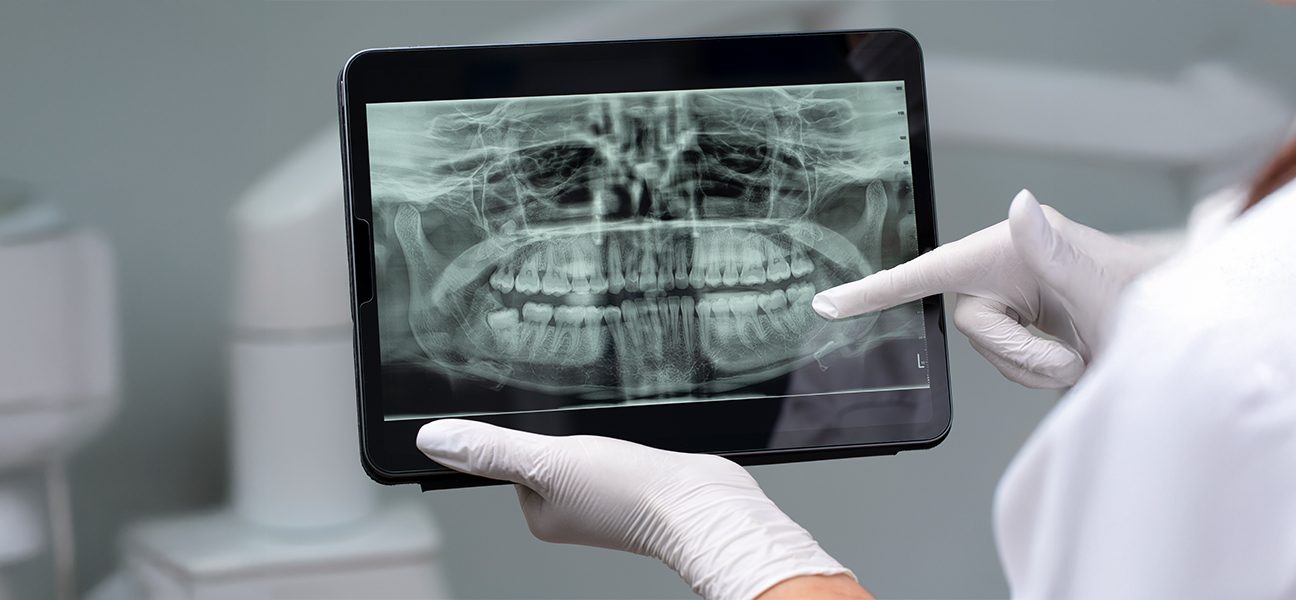 From X-Rays to Aligner Progression: A Step-by-Step Look at the ...